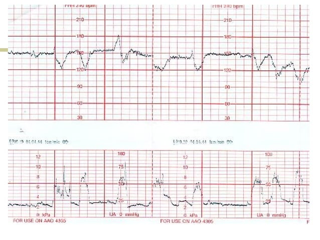 Cardiotocography (CTG) | PPT | Pregnancy | Reproductive Health