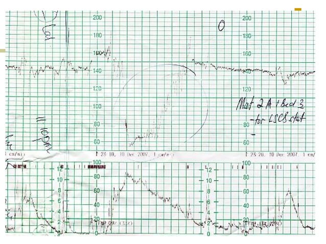 Cardiotocography (CTG) | PPT | Pregnancy | Reproductive Health