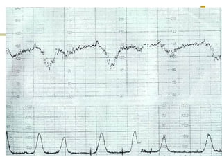 Cardiotocography (CTG) | PPT