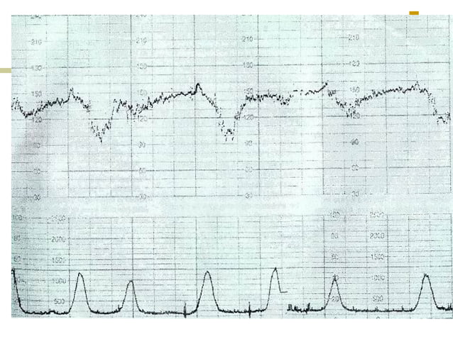 Cardiotocography (CTG) | PPT | Pregnancy | Reproductive Health