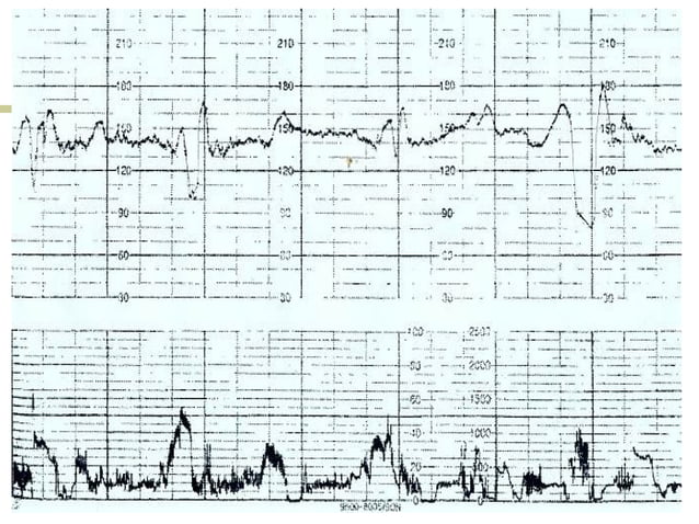 Cardiotocography (CTG) | PPT | Pregnancy | Reproductive Health