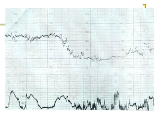 Cardiotocography (CTG) | PPT
