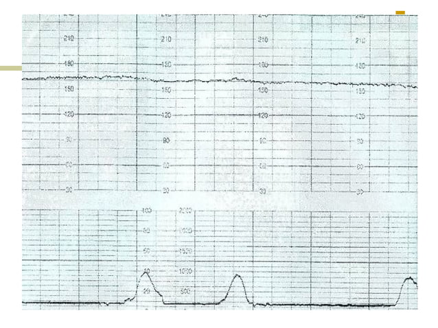 Cardiotocography (CTG) | PPT | Pregnancy | Reproductive Health