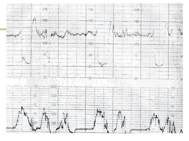 Cardiotocography (CTG) | PPT | Pregnancy | Reproductive Health