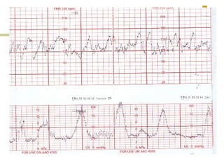 Cardiotocography (CTG) | PPT