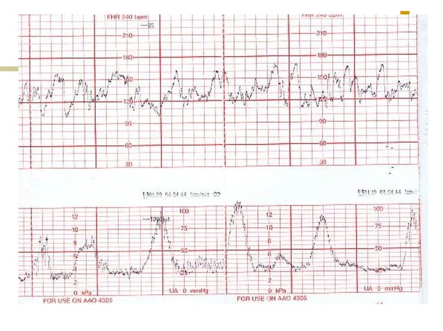 Cardiotocography (CTG) | PPT | Pregnancy | Reproductive Health