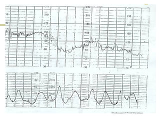 Cardiotocography (CTG) | PPT