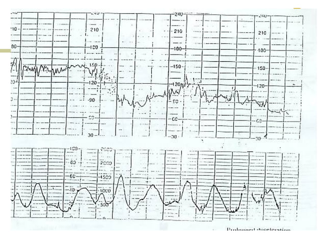 Cardiotocography (CTG) | PPT | Pregnancy | Reproductive Health