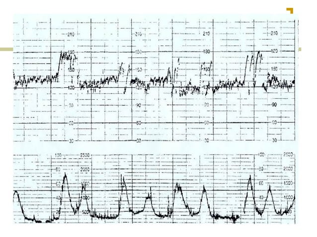 Cardiotocography (CTG) | PPT