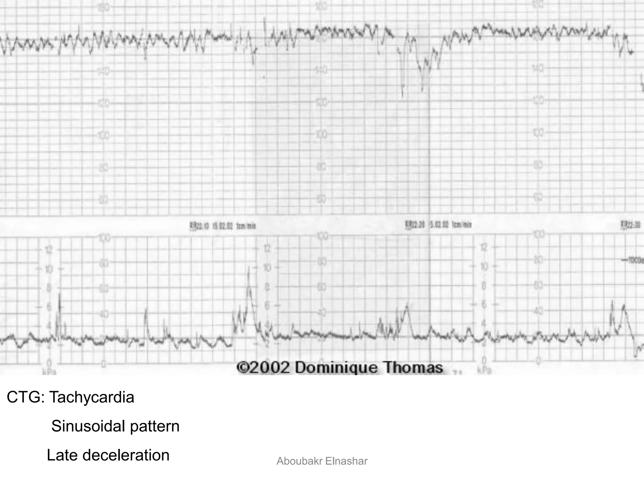 Cardiotocography: CTG antepartum and intrapartum | PDF