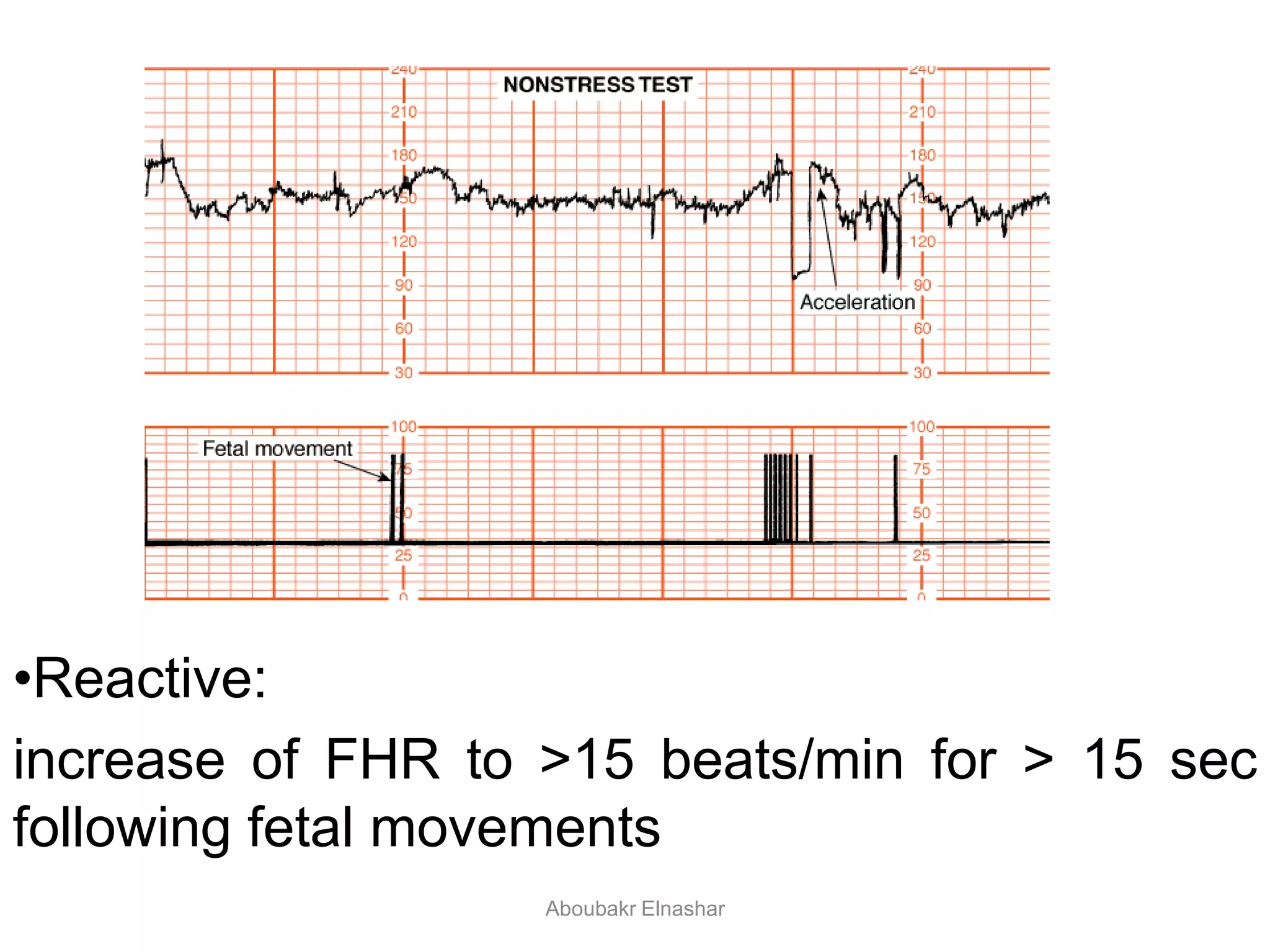 Cardiotocography: CTG antepartum and intrapartum | PDF