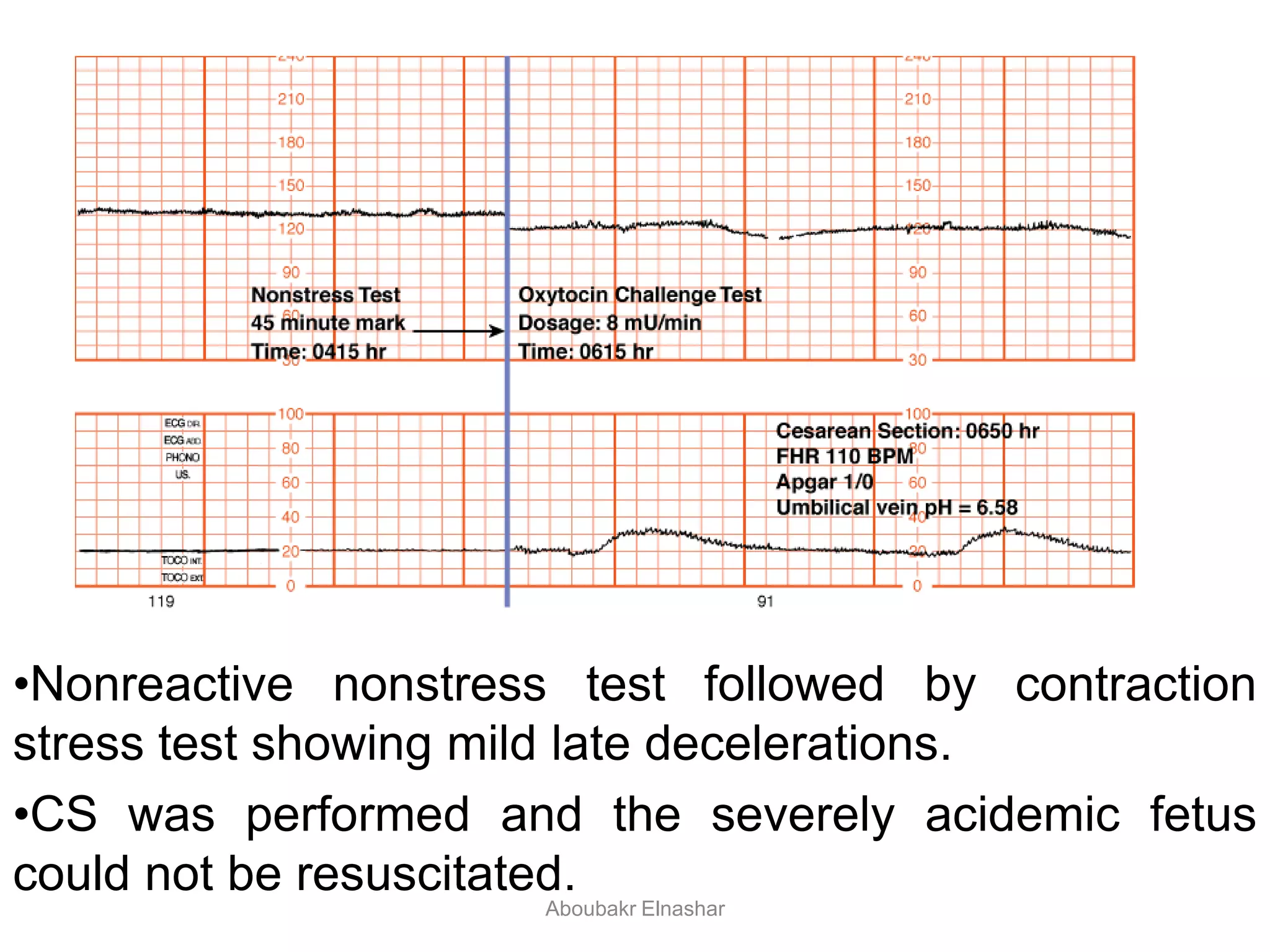Cardiotocography: CTG antepartum and intrapartum | PDF
