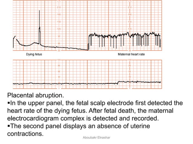 Cardiotocography: CTG antepartum and intrapartum | PDF