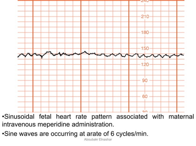 Cardiotocography: CTG antepartum and intrapartum | PDF