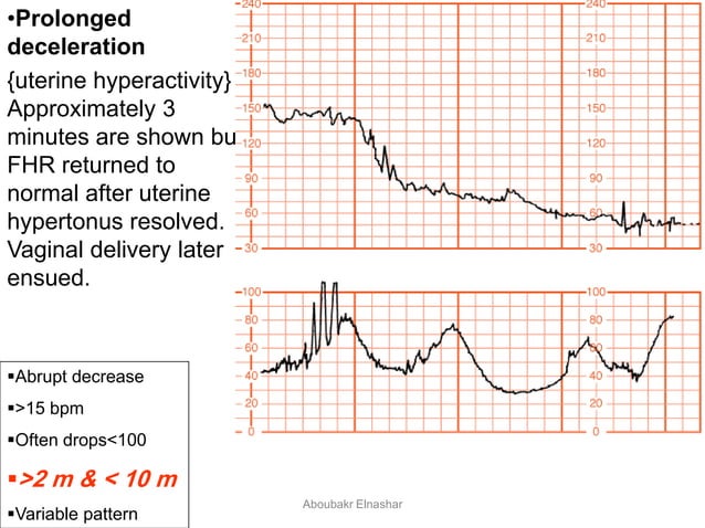 Cardiotocography: CTG antepartum and intrapartum | PDF