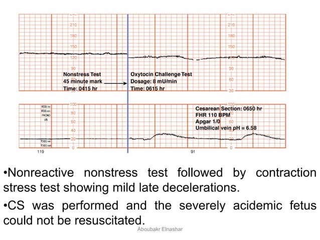 Cardiotocography: CTG antepartum and intrapartum | PDF