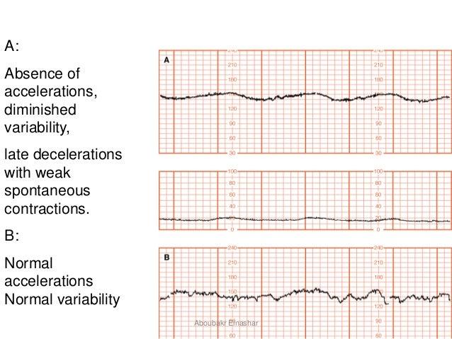 Cardiotocography: CTG antepartum and intrapartum