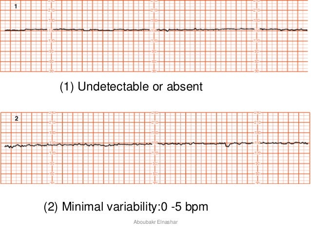 Cardiotocography: CTG antepartum and intrapartum