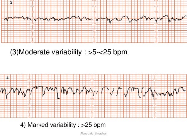 Cardiotocography: CTG antepartum and intrapartum