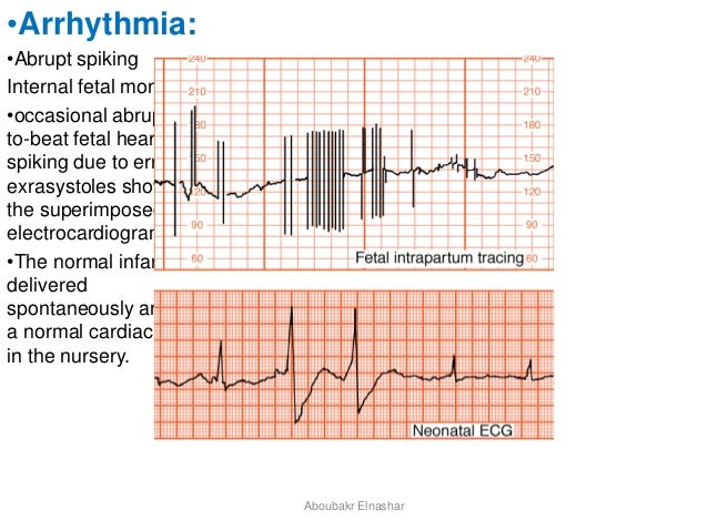 Cardiotocography: CTG antepartum and intrapartum