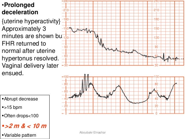 Prolonged Decelerations
