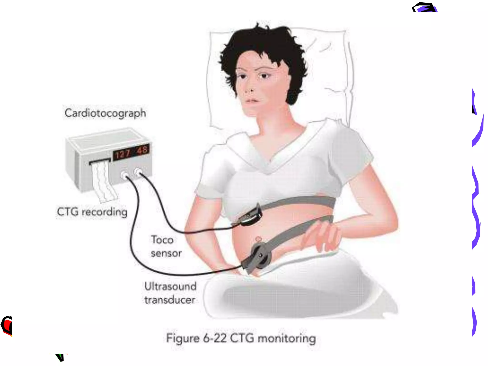 Cardiotocography | PPTX | Pregnancy | Reproductive Health