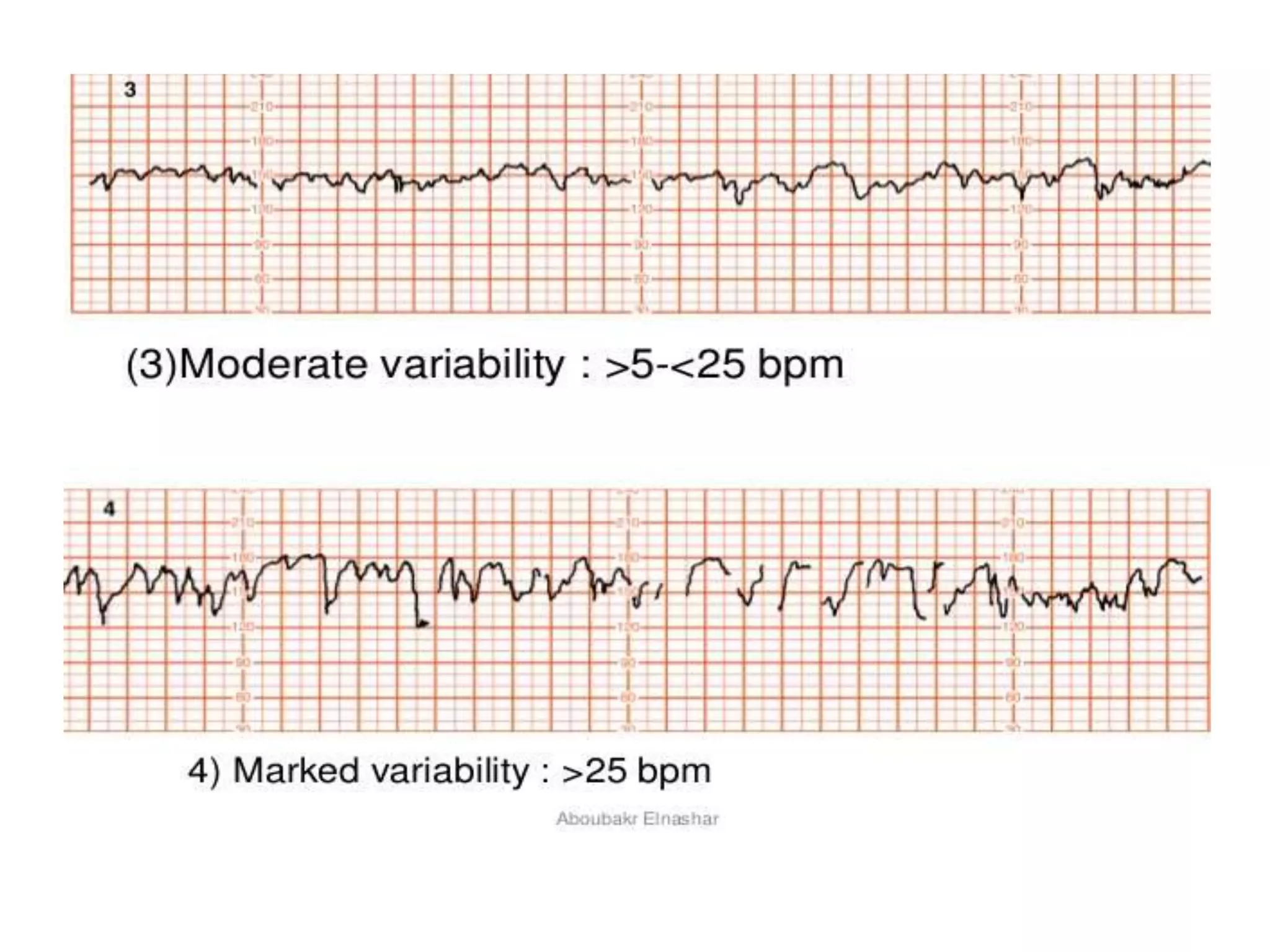 Cardiotocography | PPTX