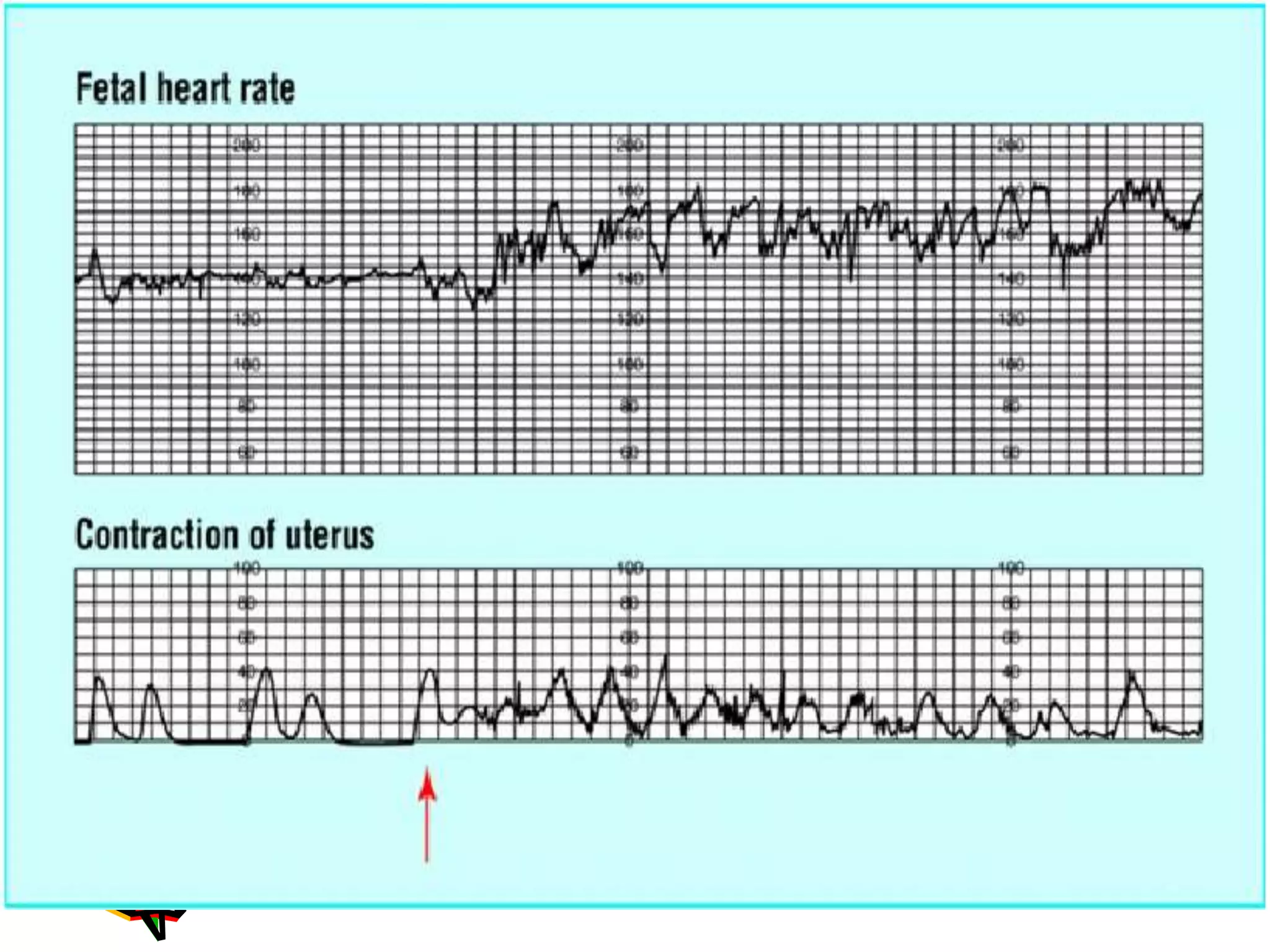 Cardiotocography | PPTX