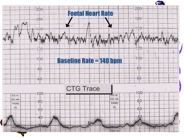 Cardiotocography | PPTX | Pregnancy | Reproductive Health