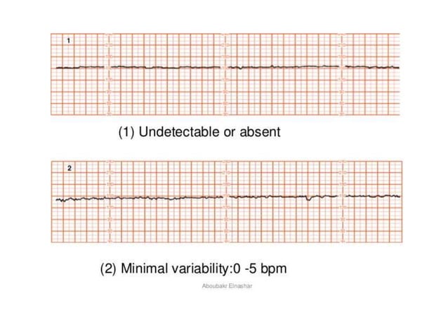 Cardiotocography | PPTX | Pregnancy | Reproductive Health