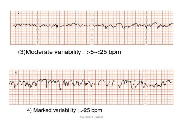 Cardiotocography | PPTX | Pregnancy | Reproductive Health