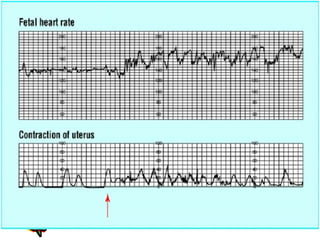Cardiotocography | PPTX