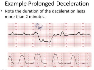 Prolonged Decelerations