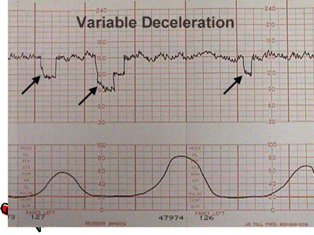 Cardiotocography