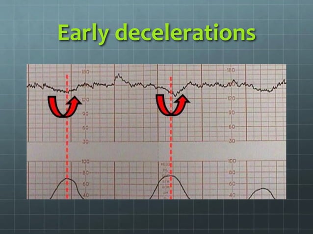 Cardiotocography | PDF