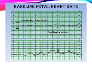 ELECTRONIC FETAL MONITORING CARDIOTOCOGRAPH IN THE MANAGEMENT OF LABOUR ...