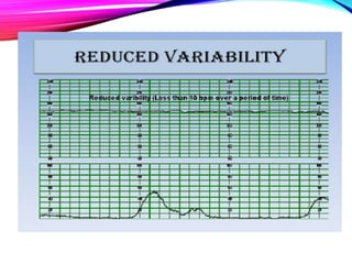 ELECTRONIC FETAL MONITORING CARDIOTOCOGRAPH IN THE MANAGEMENT OF LABOUR ...