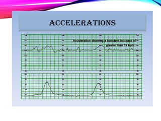 ELECTRONIC FETAL MONITORING CARDIOTOCOGRAPH IN THE MANAGEMENT OF LABOUR ...