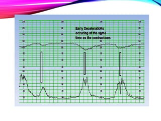ELECTRONIC FETAL MONITORING CARDIOTOCOGRAPH IN THE MANAGEMENT OF LABOUR ...