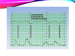 ELECTRONIC FETAL MONITORING CARDIOTOCOGRAPH IN THE MANAGEMENT OF LABOUR ...