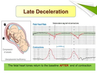 Reactive Fetal Heart Rate Tracing