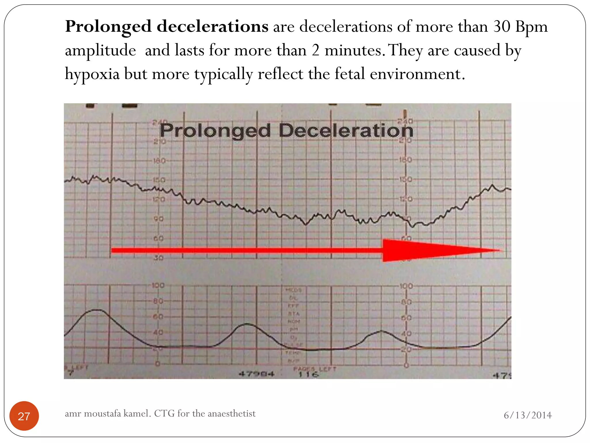 CTG for the anaesthetist | PPTX