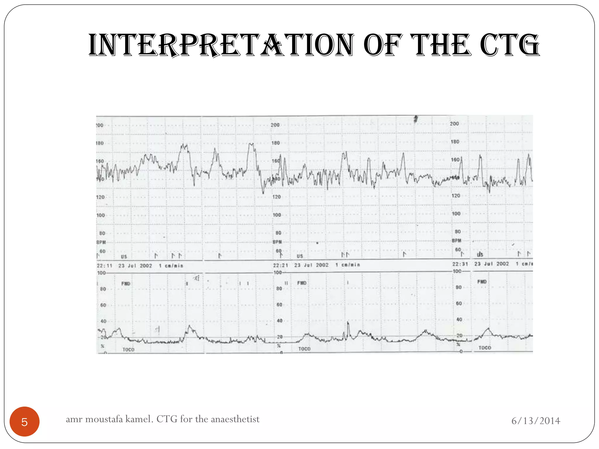 CTG for the anaesthetist | PPTX