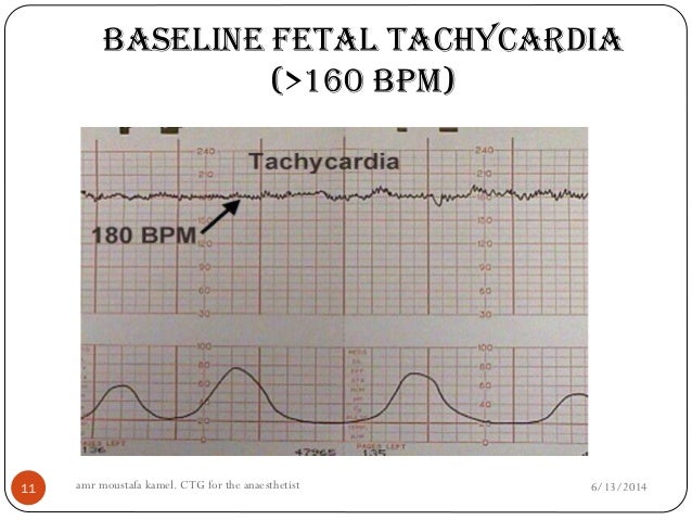 CTG for the anaesthetist