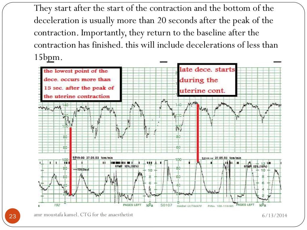 CTG for the anaesthetist