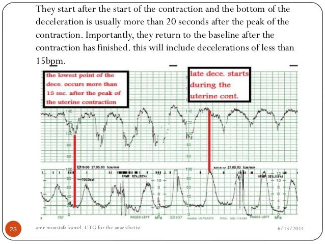 CTG for the anaesthetist