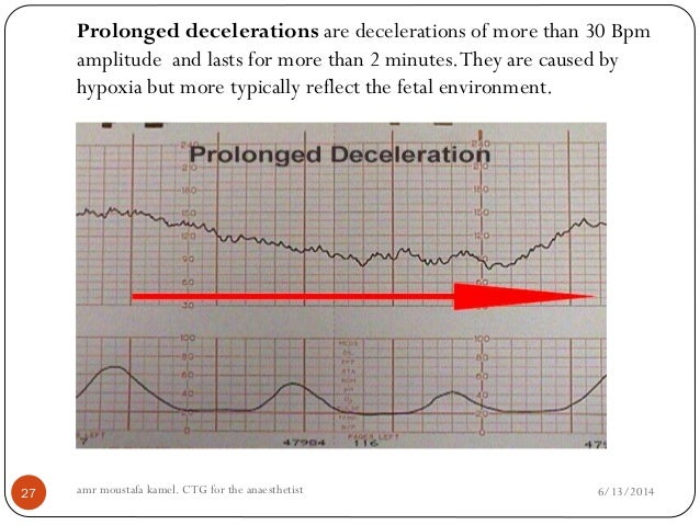 CTG for the anaesthetist