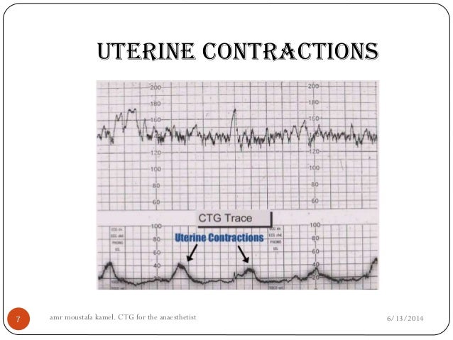CTG for the anaesthetist