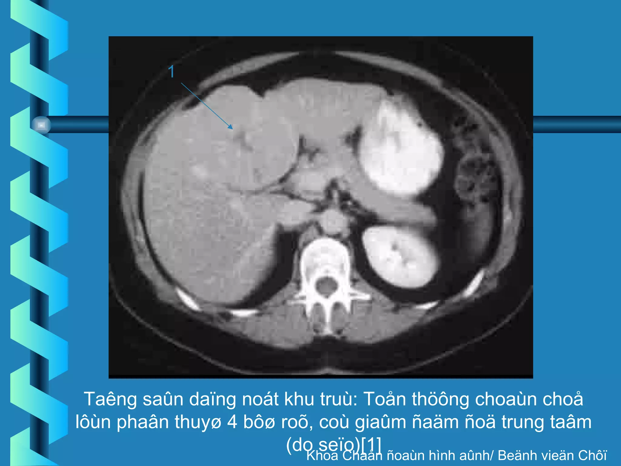 Ct giai phau bung & u gan | PPT
