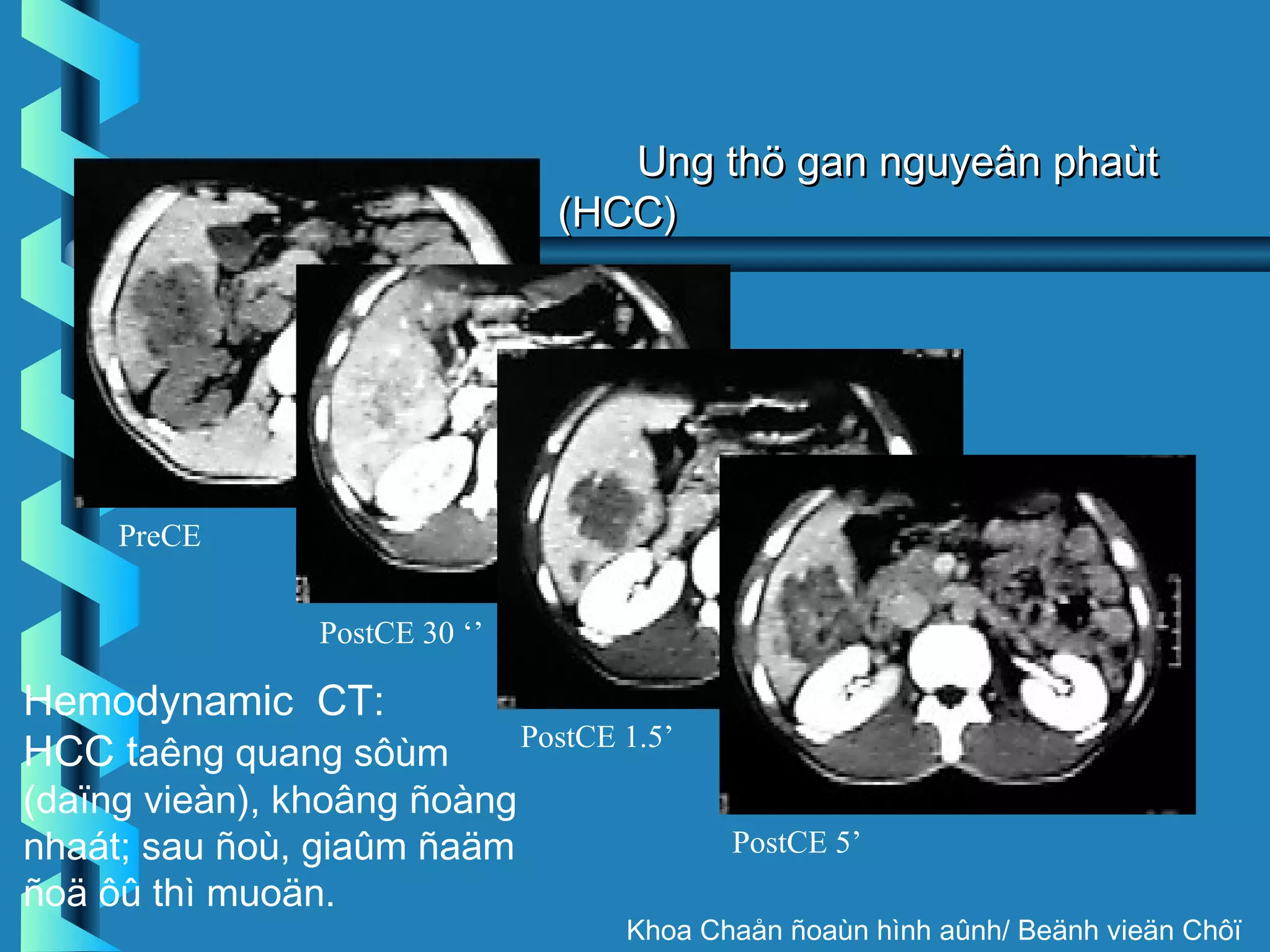 Ct giai phau bung & u gan | PPT
